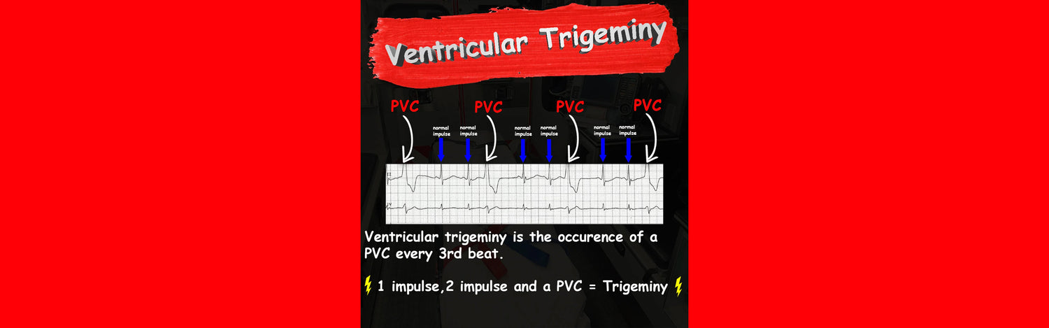 Ventricular Trigeminy || EMS Cardiology – Lights Sirens Action EMS